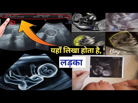 Ultrasound Report | How to know baby boy or girl in ultrasound report ...