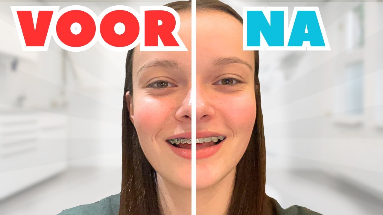 Mijn Beugel Gaat Eruit!!! | vlog #9 - YouTube