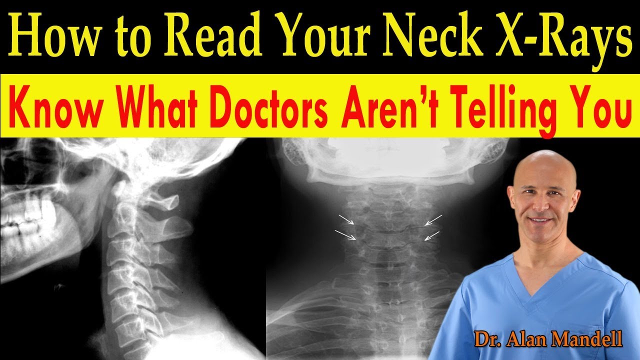 How to Read Your Neck X-rays / Know What Doctors Are Not Telling You ...