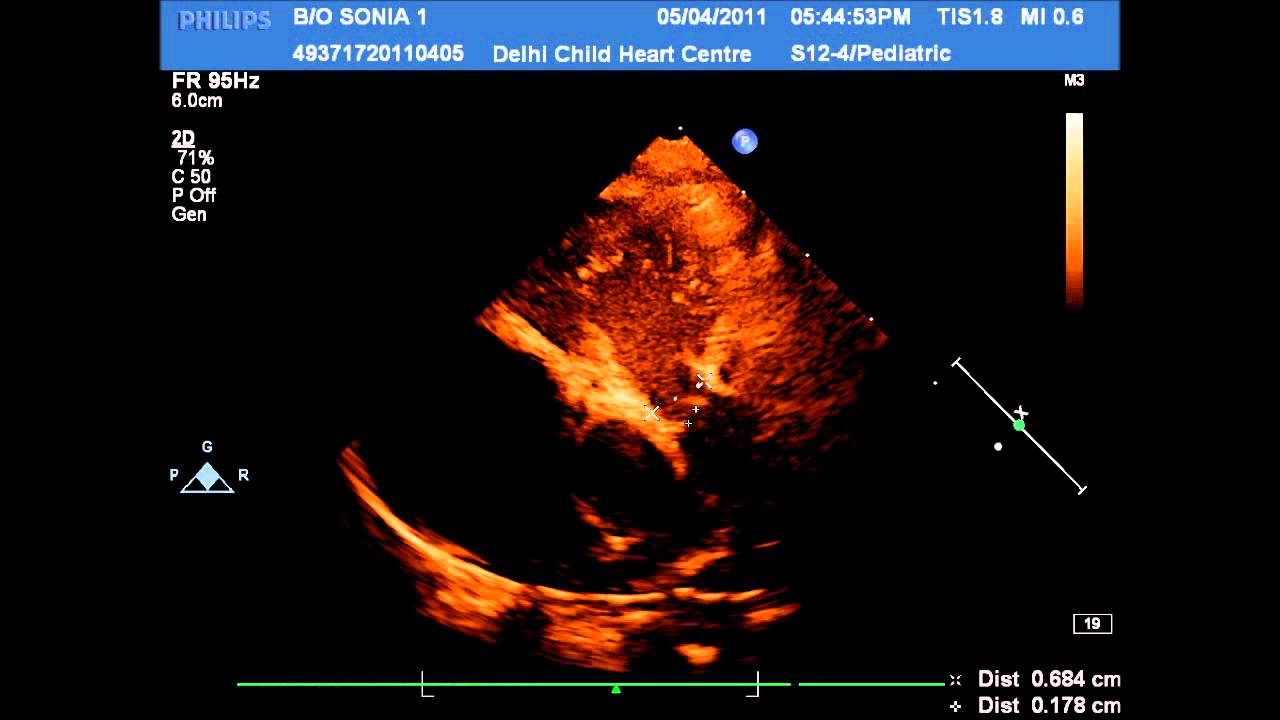 Postnatal Echo of baby after birth of the baby - YouTube
