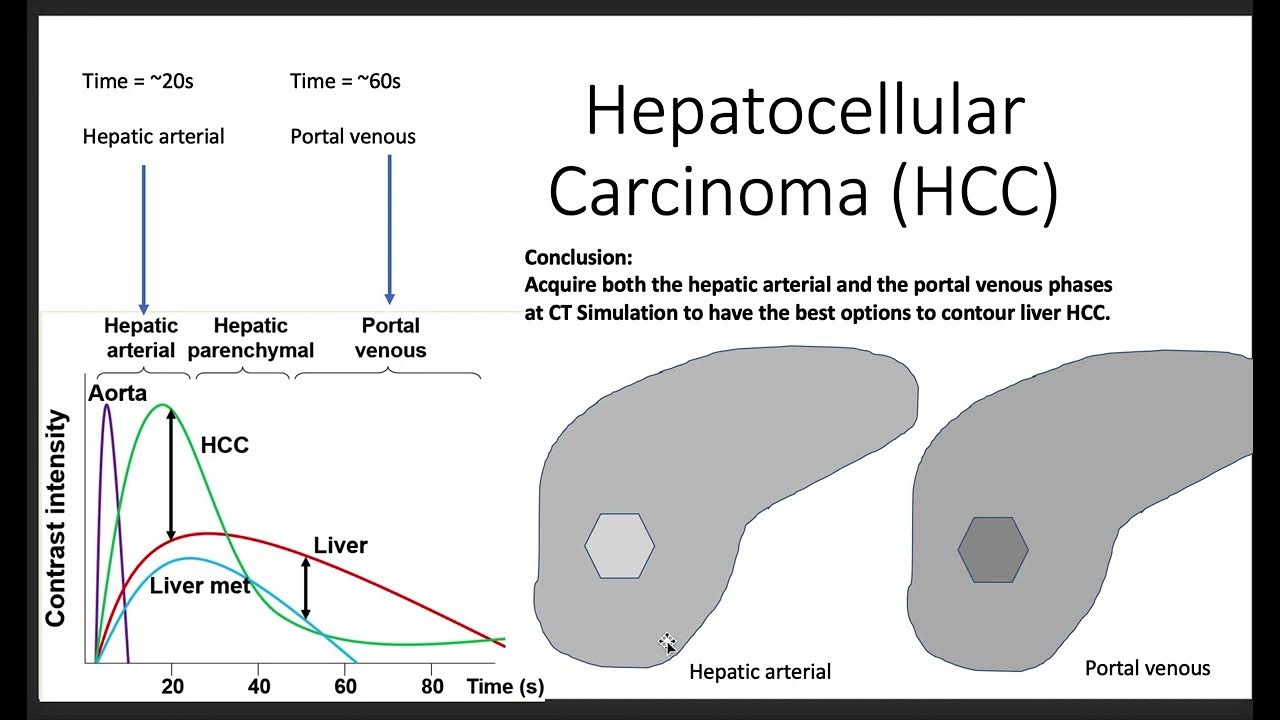 Liver SBRT IV contrast phases explained - YouTube