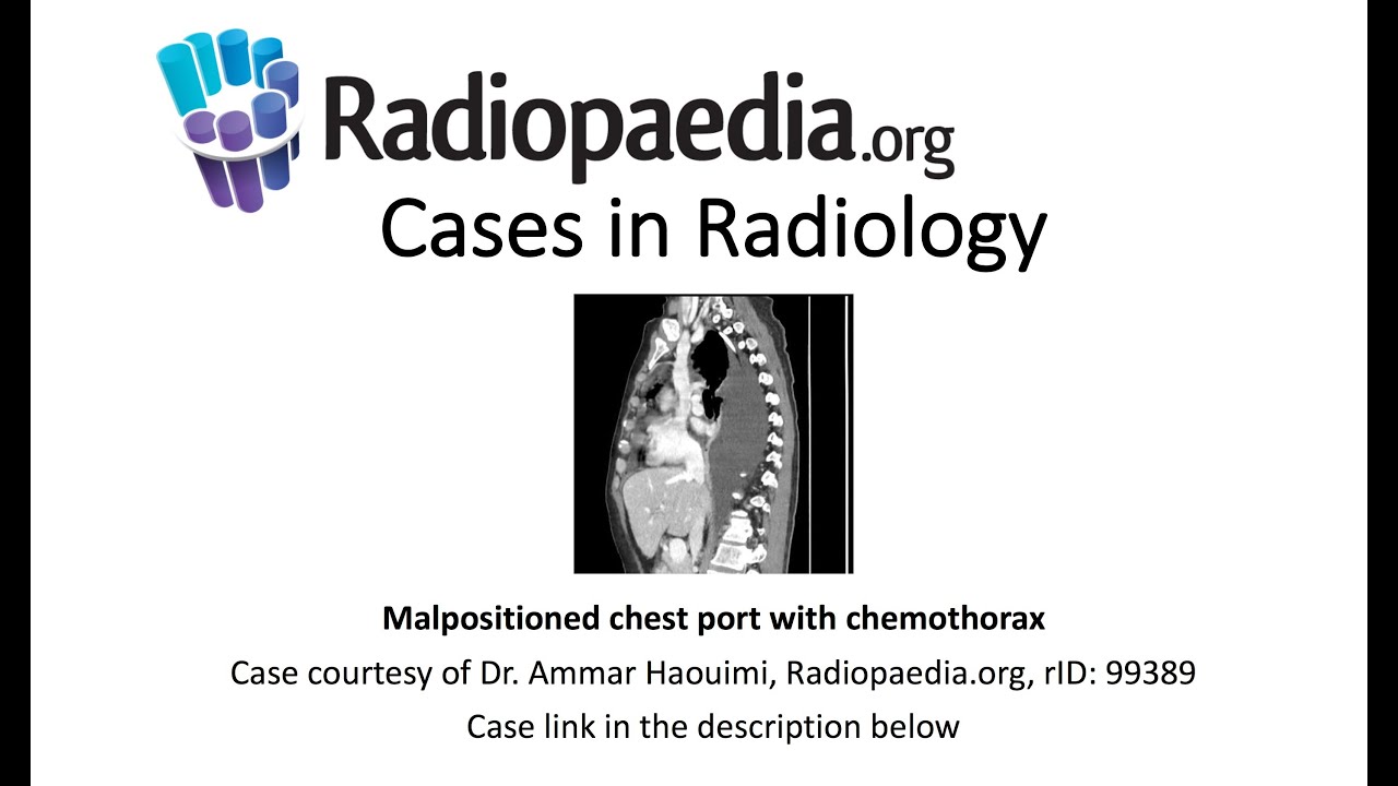 Malpositioned chest port with chemothorax (Radiopaedia.org) Cases in ...