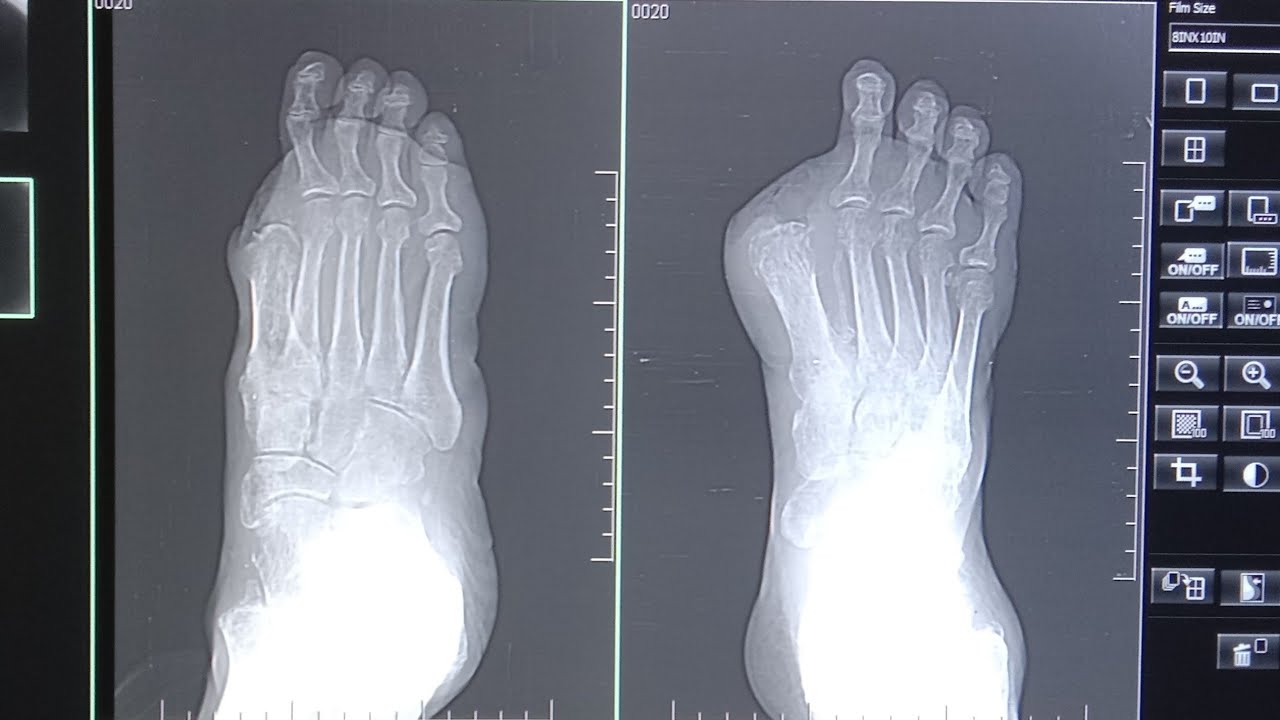 X ray foot Ap and Lateral view || diabetic foot 👣 - YouTube
