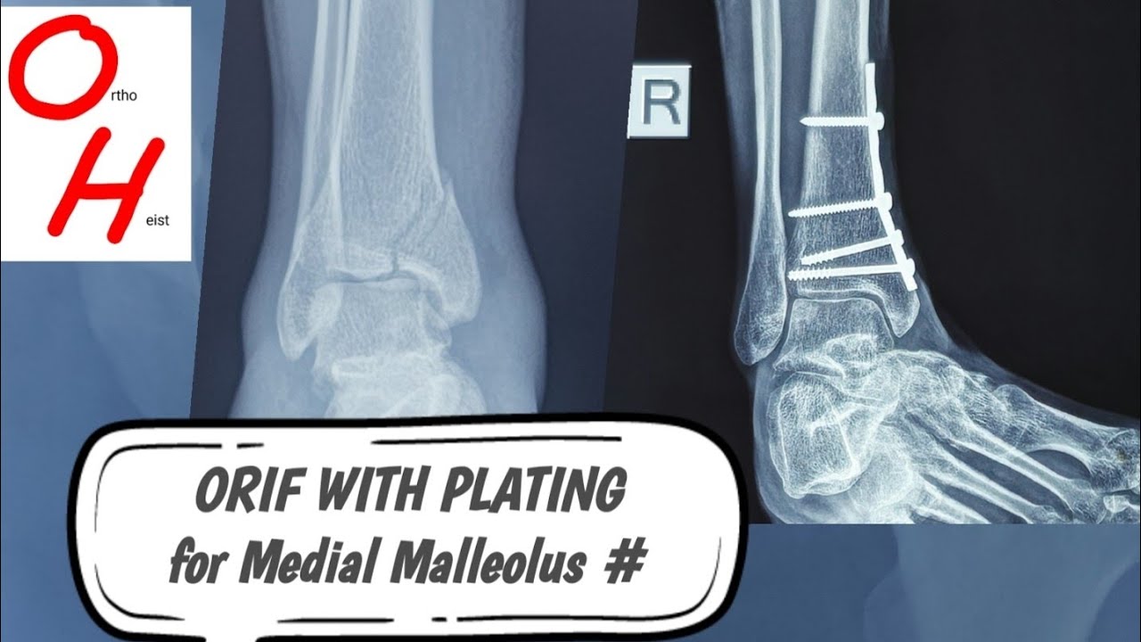 ORIF WITH PLATING FOR MEDIAL MALLEOLOUS FRACTURE - YouTube
