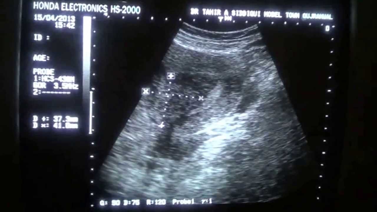 posterior wall UTERINE FIBROID with MASS EFFECT on endometrial canal ...