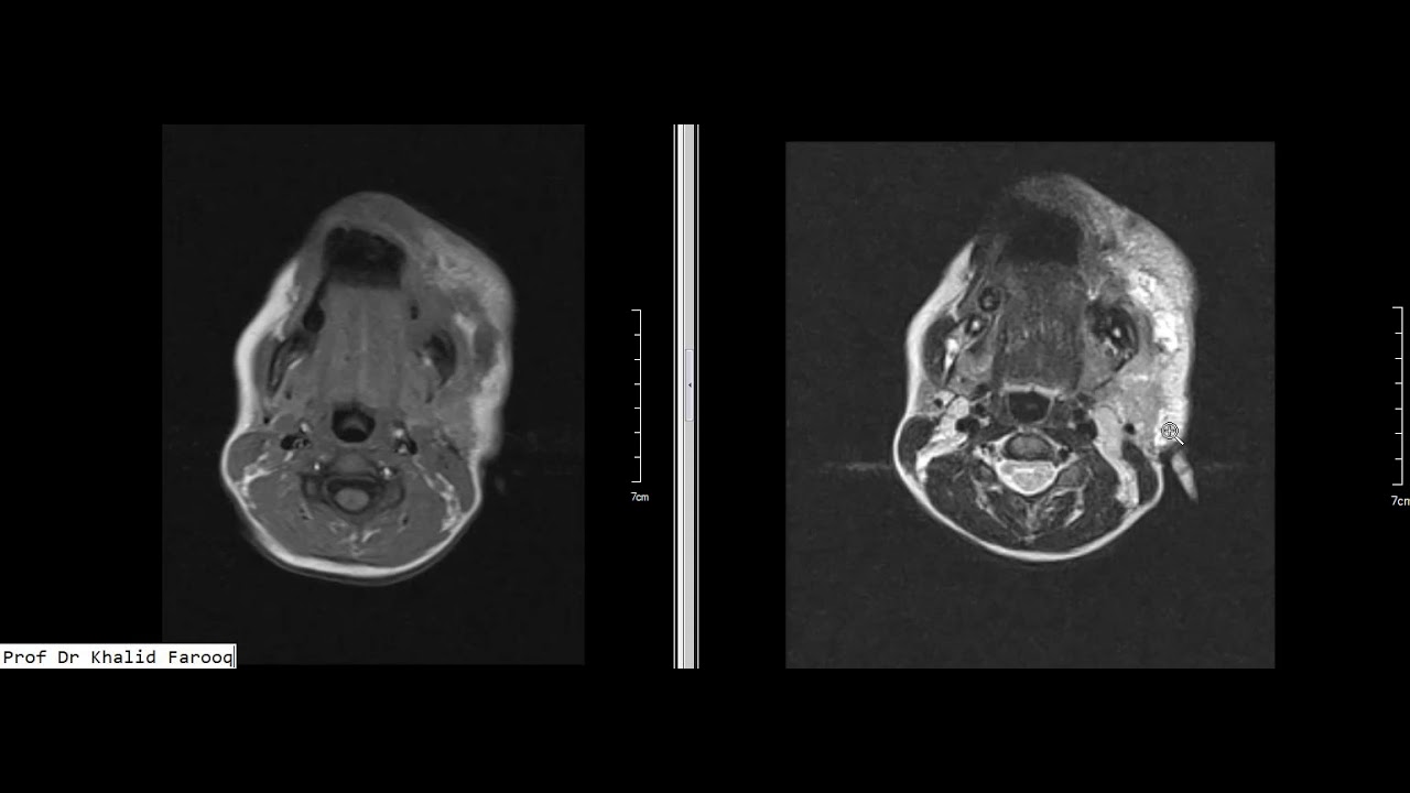 mri face NF1 - YouTube