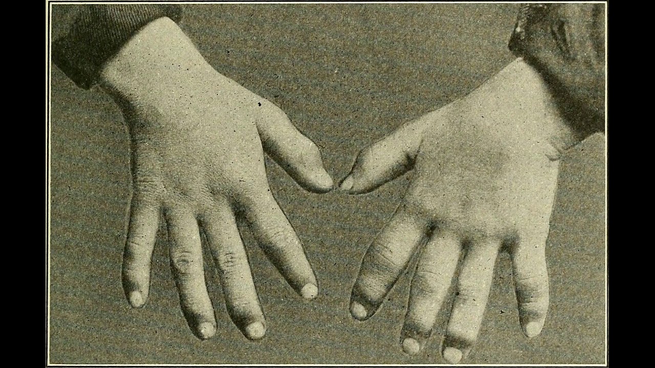 Dactylitis - YouTube