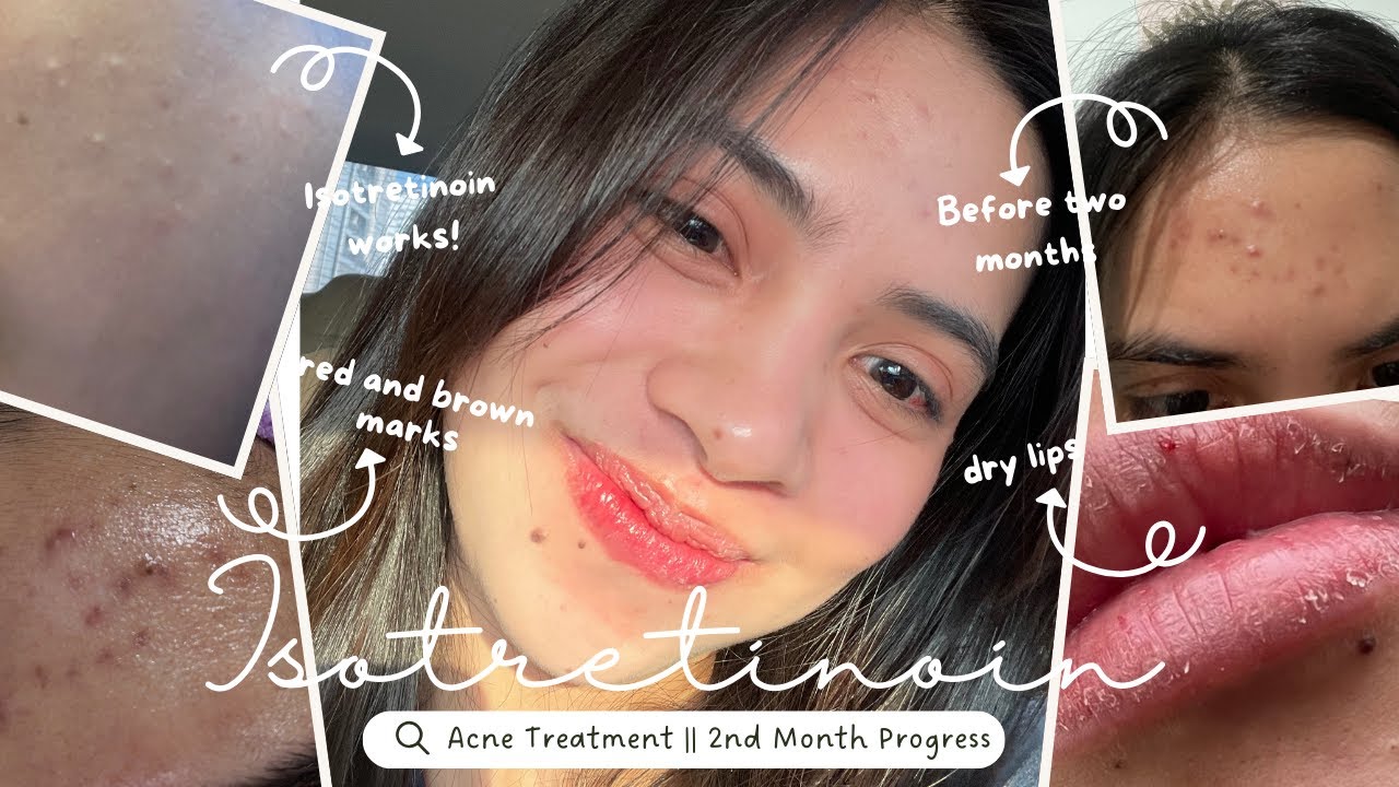 Accutane Journey | Two Months Progress: Road to Clear Skin? - YouTube