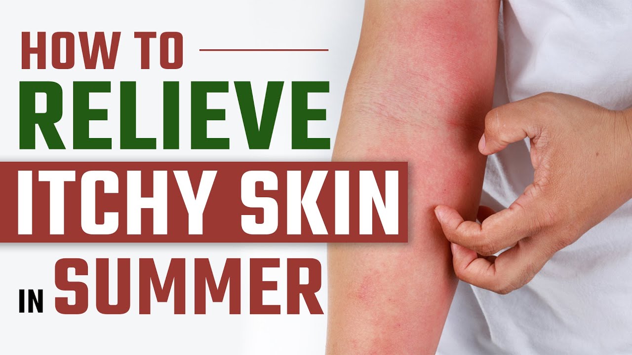 How to Relieve Itchy Skin in Summer | Home Remedies for Skin Allergy ...
