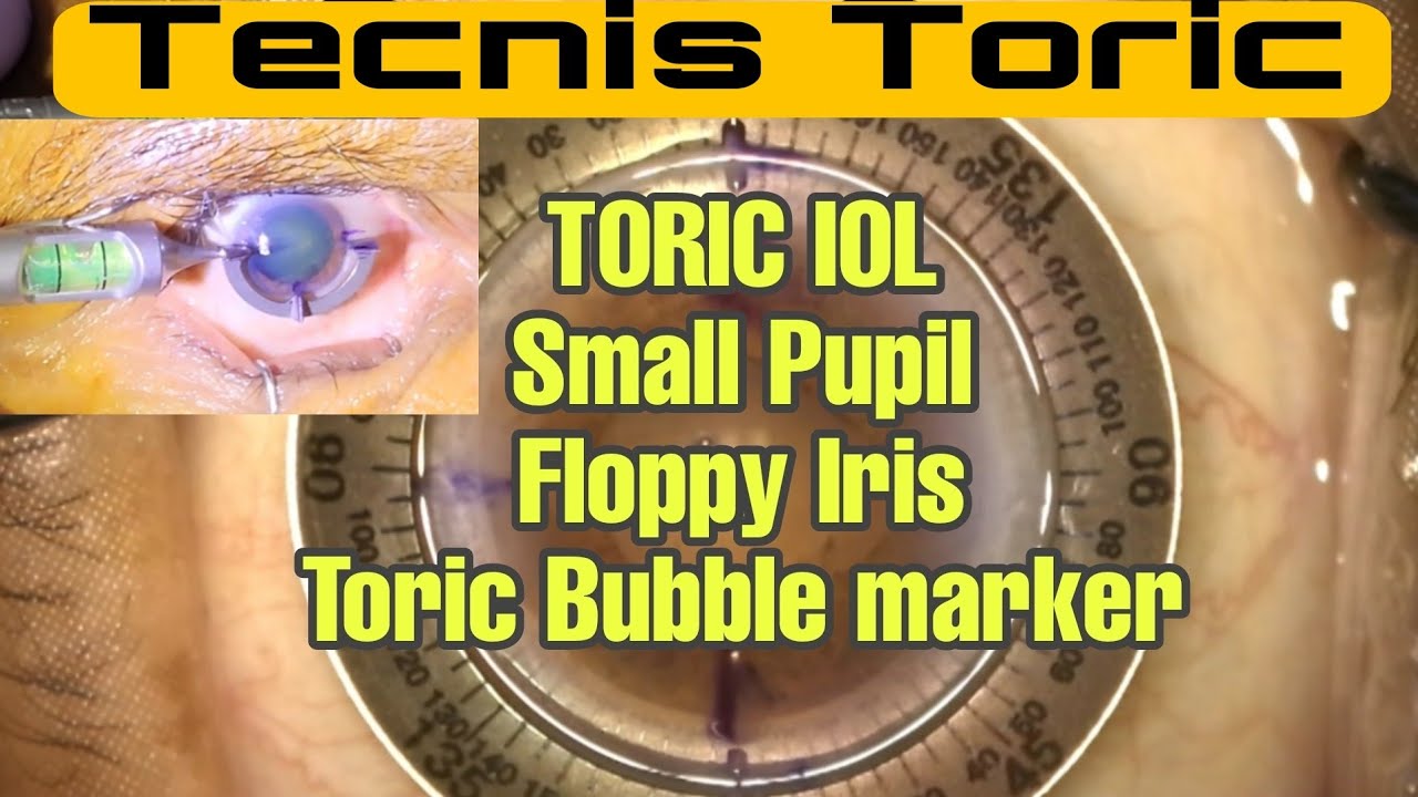 #157 Toric IOL in a small pupil | Toric Bubble Marker | Axis Marking ...
