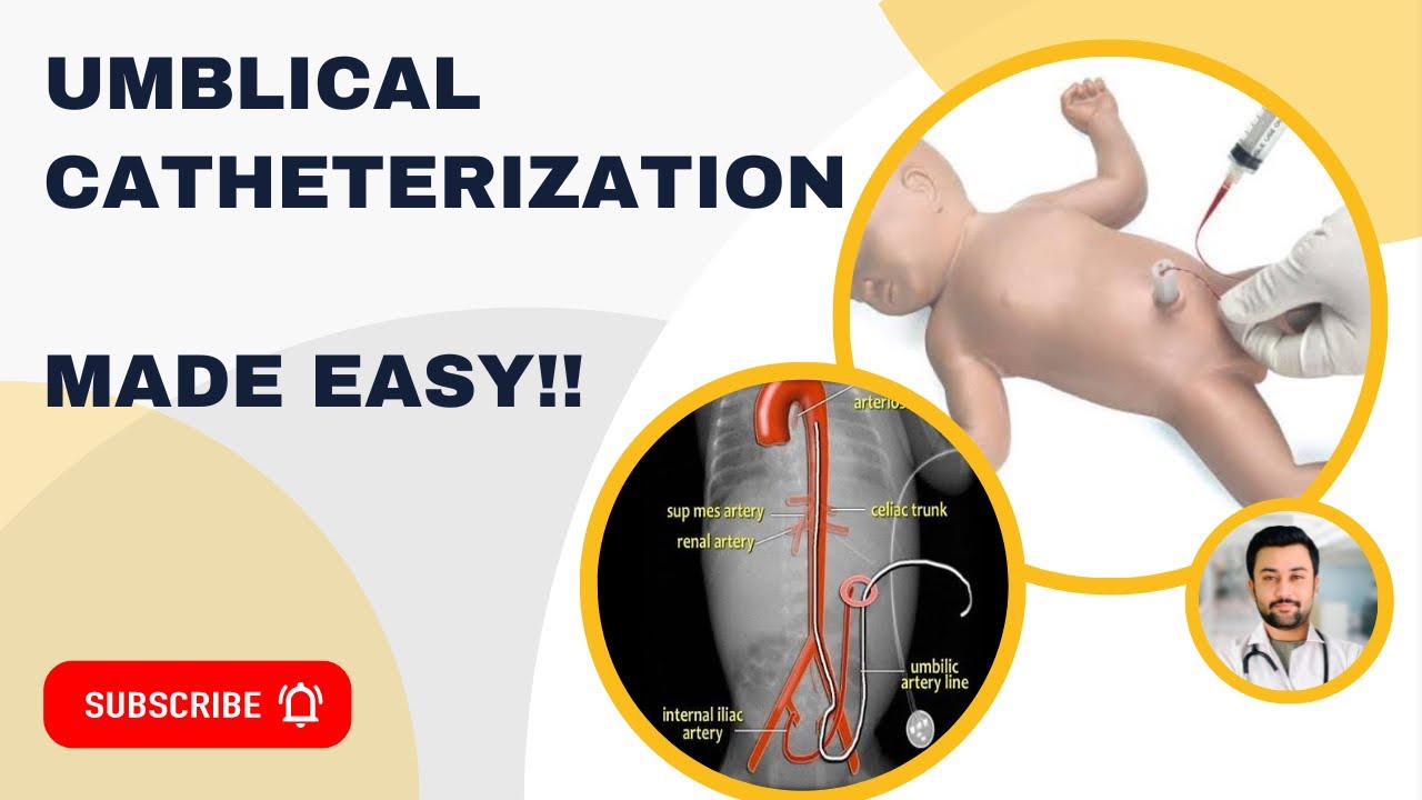 Neonates Umblical catheterization !!! - YouTube