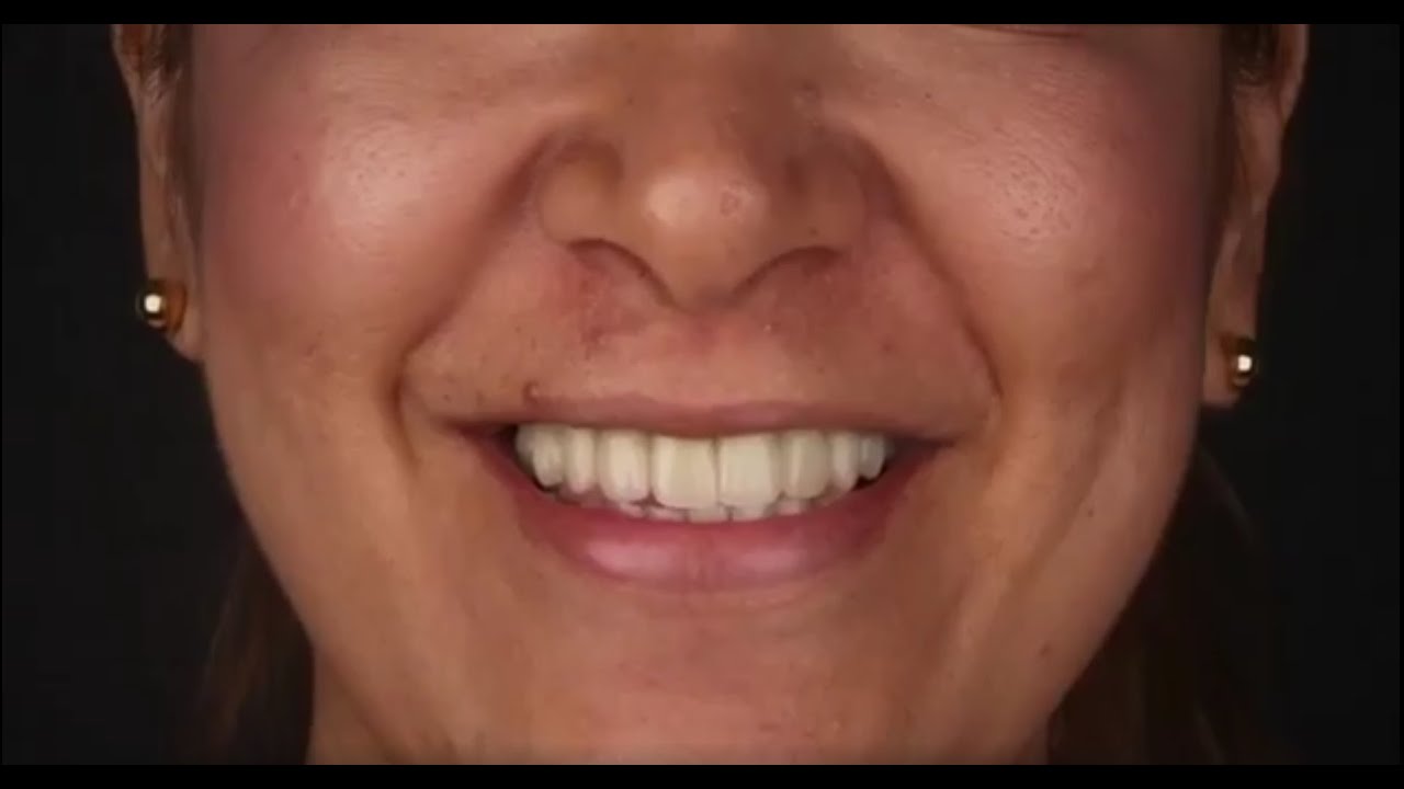 PANDA P2 Intraoral Scanner | Amazing Work by Dr. Ricado Velazquez - YouTube