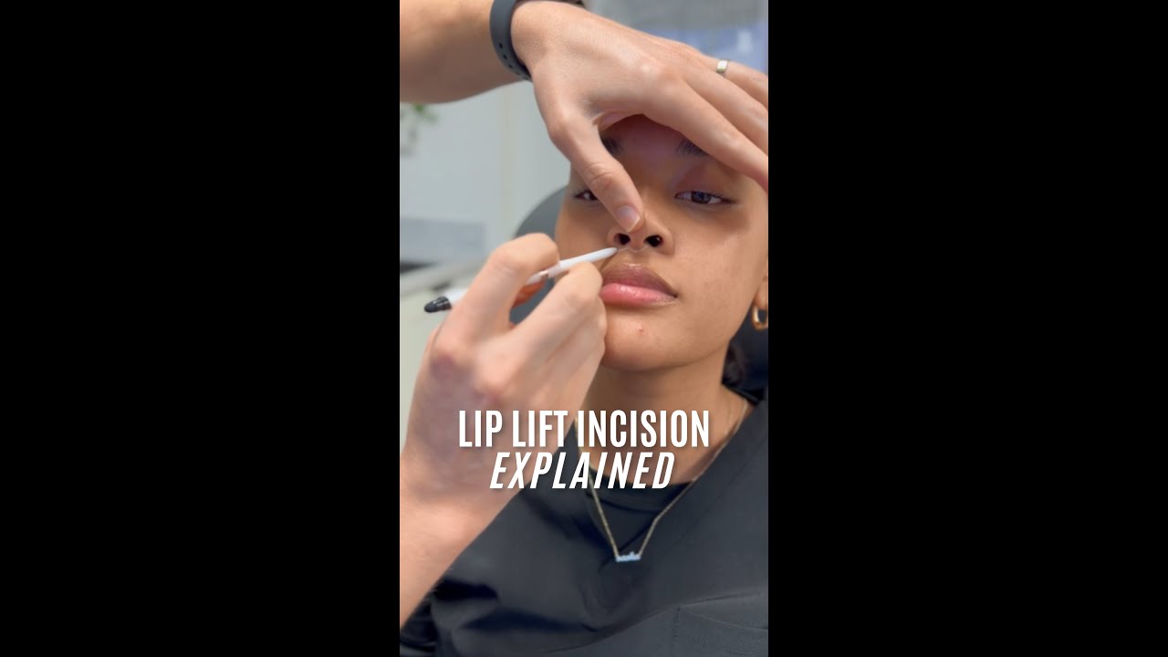 Lip Lift Incisions Explained | Dr. Brandyn Dunn, Facial Plastic Surgeon ...