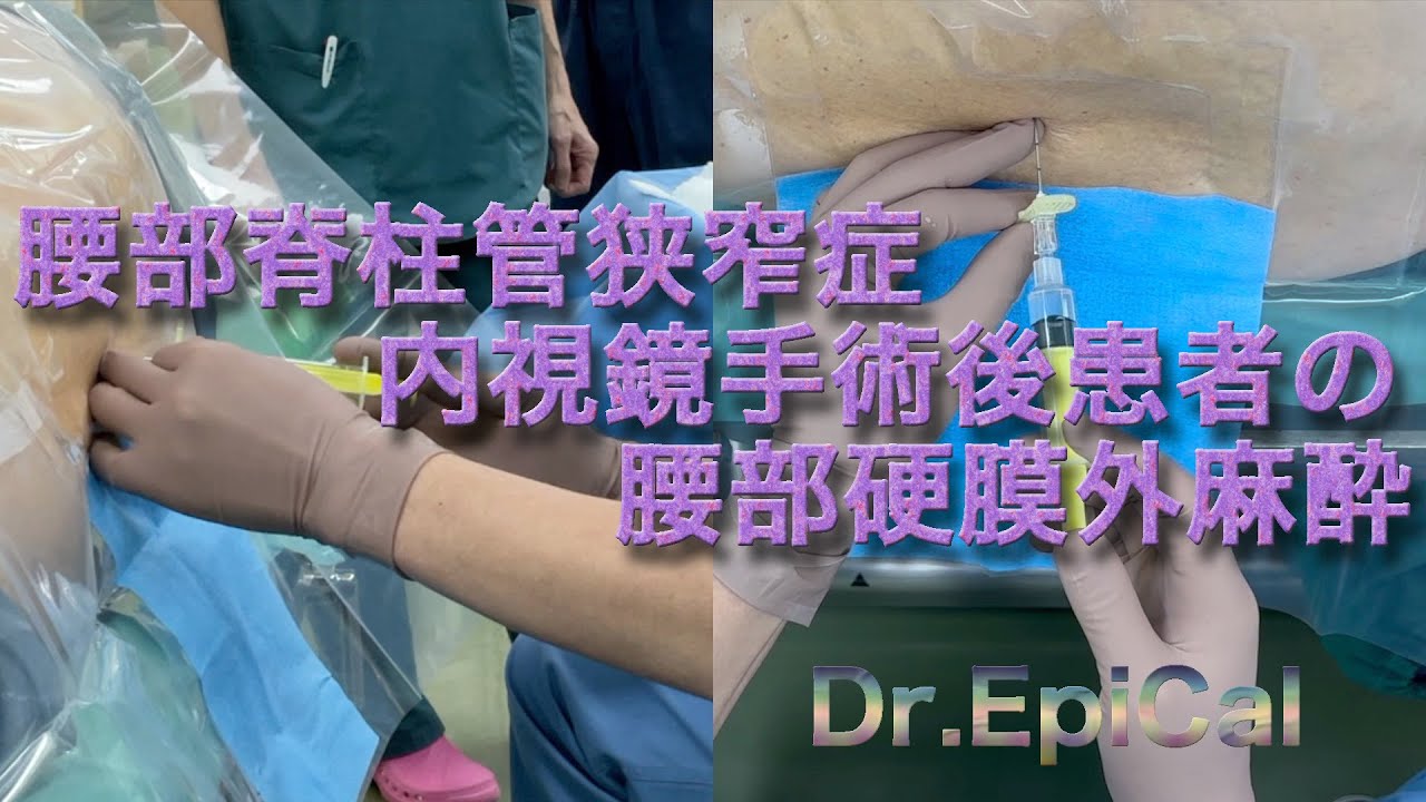 腰部脊柱管狭窄症・内視鏡手術後患者の腰部硬膜外麻酔 epidural anesthesia by Dr.EpiCal - YouTube