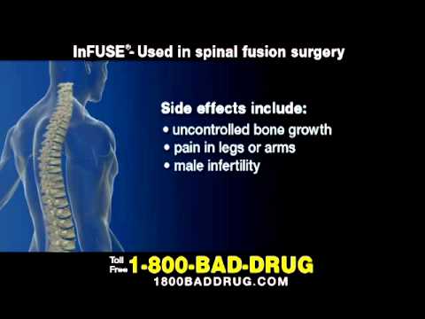 InFUSE Bone Graft Side Effect Lawsuits - YouTube