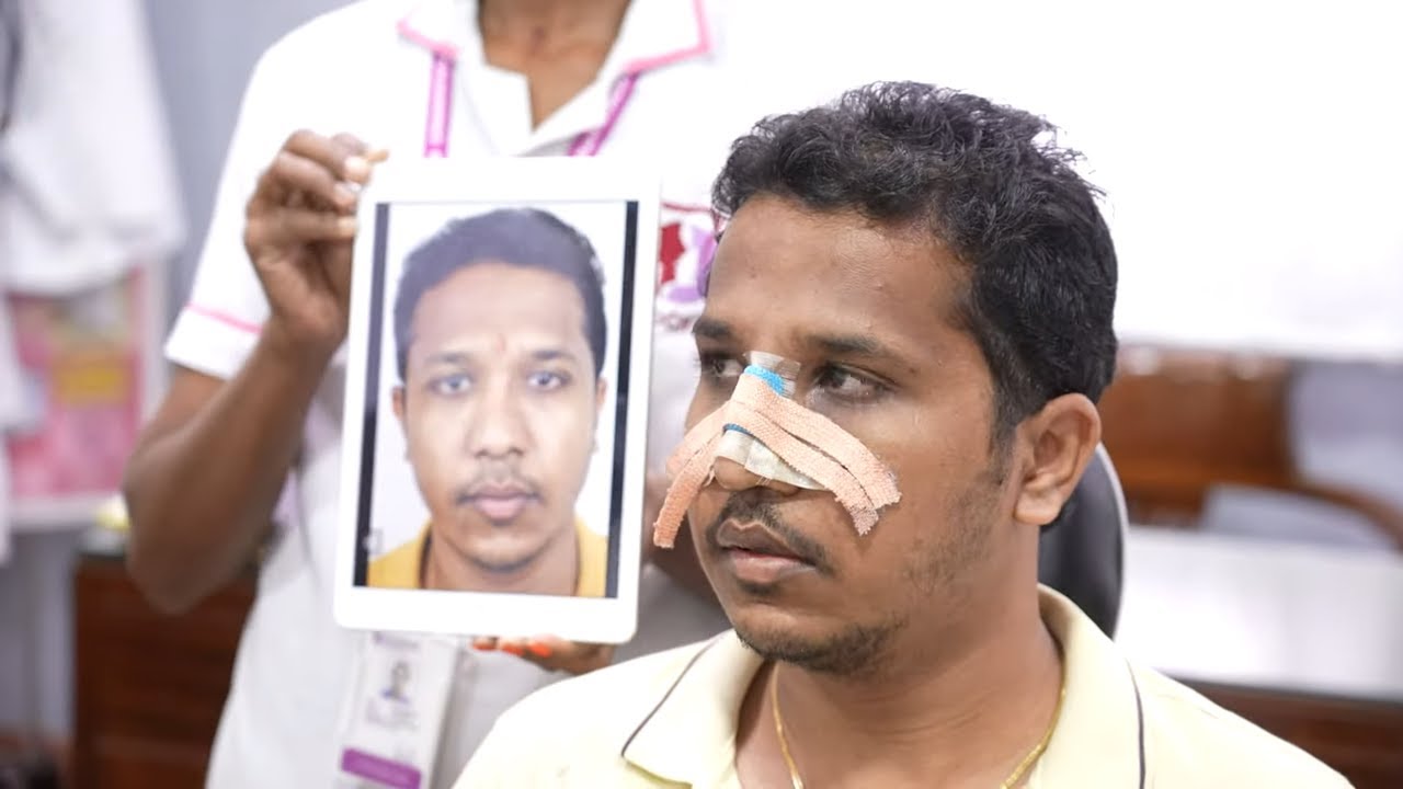 Recovery After Nose Job - Plastic Surgery | Splint Removal by Dr. Sunil ...
