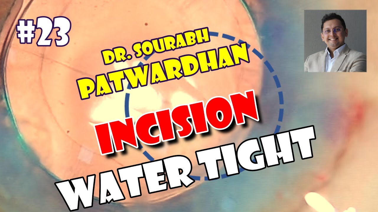 Commented 23 Incision not watertight Dr Sourabh Patwardhan - YouTube