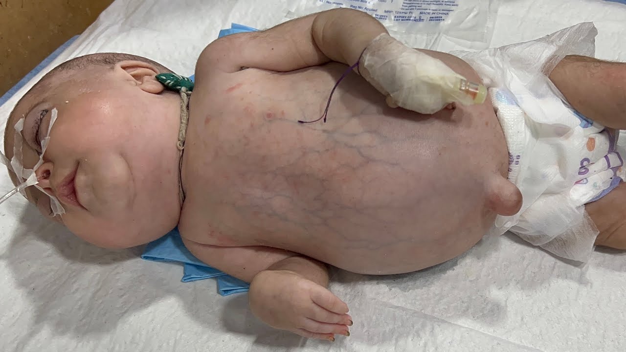 NEC suspected newborn — NG tube decompression step-by-step in NICU ...
