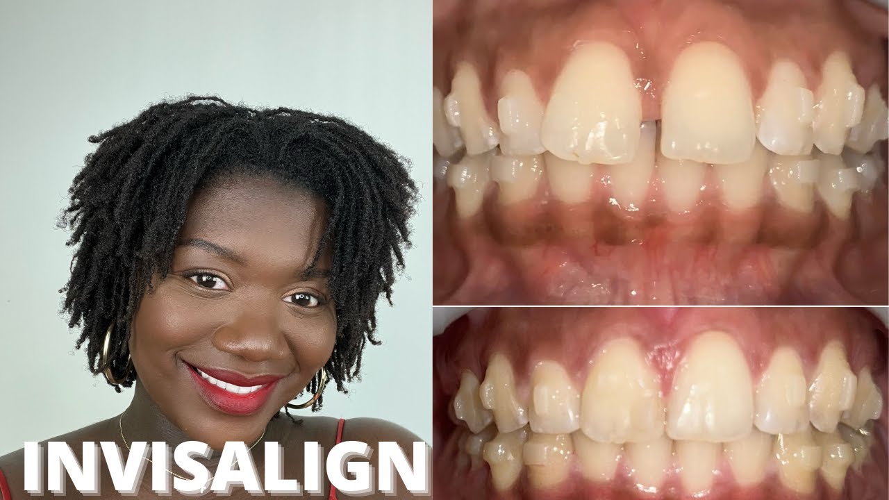 THE TRUTH ABOUT INVISALIGN - FINAL RESULTS! - YouTube