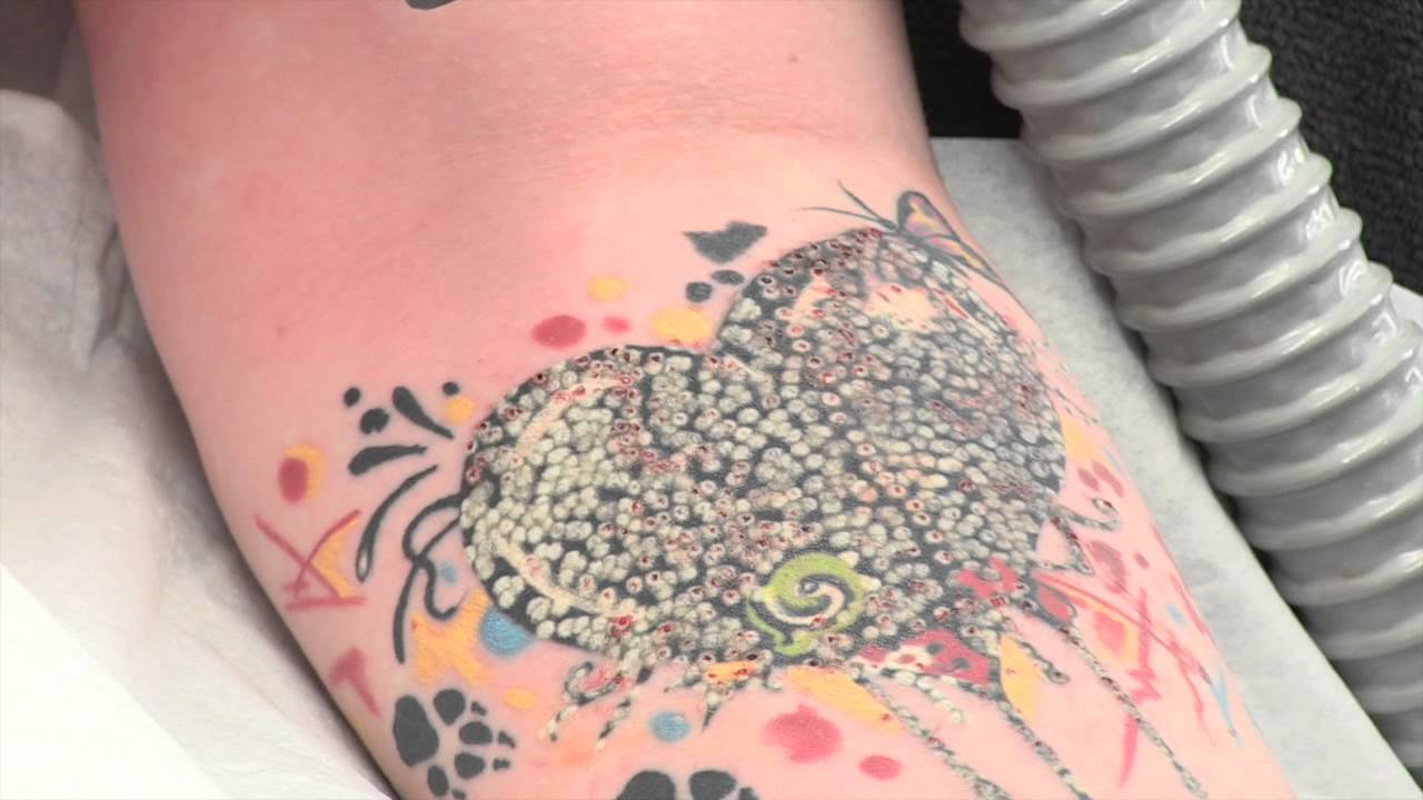 Tattoo Removal Laser Treatment at Beauty Advance - YouTube