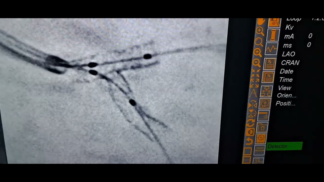 Left main bifurcation- reverse TAP stenting LM-LAD and LCX ...