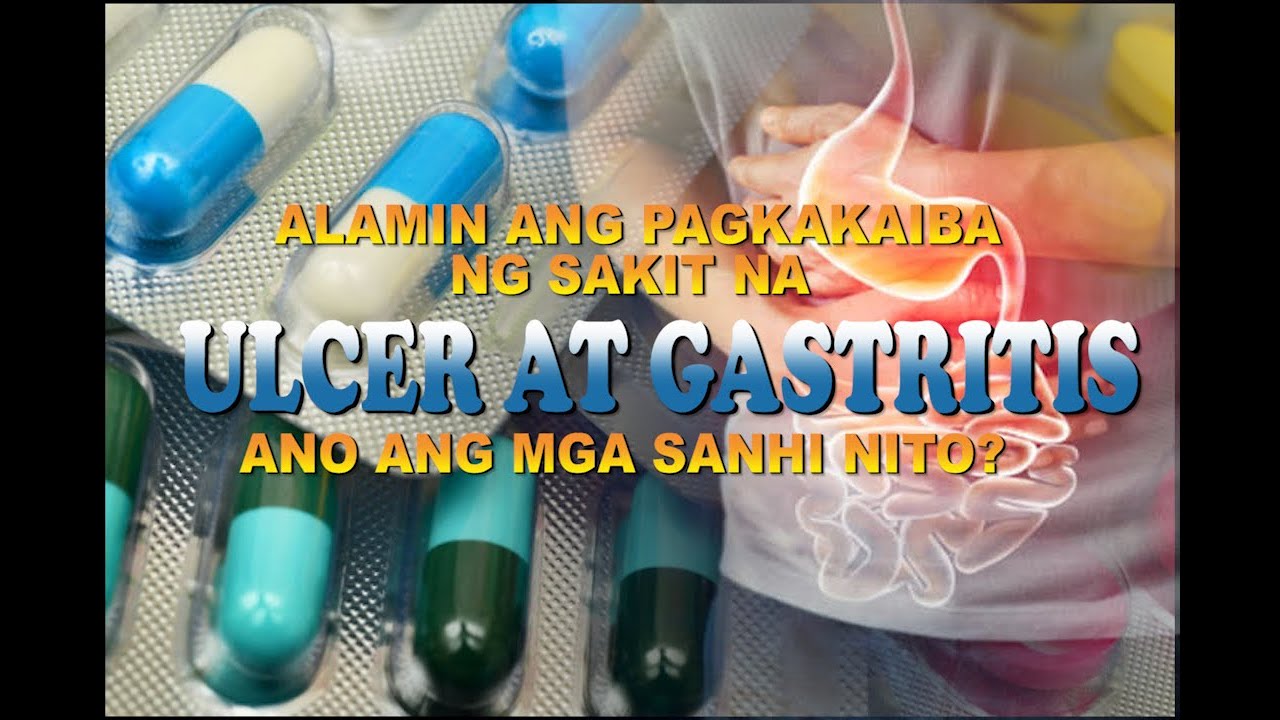 Alamin| Tips ni Doc Abas ang pagkakaiba ng Ulcer at Acute Gastritis ...