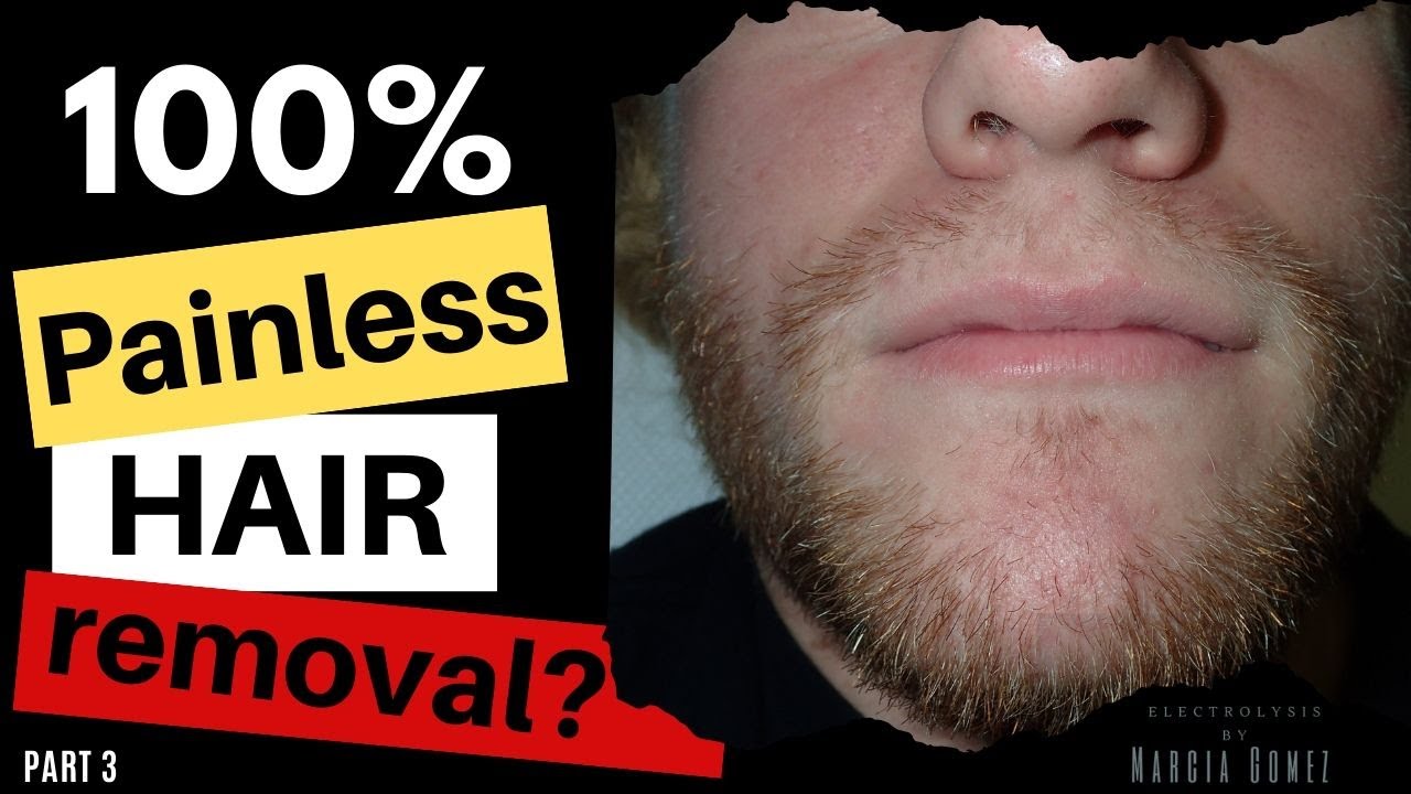 Beard Removal (Part 3) Electrolysis: The truth about painless hair ...