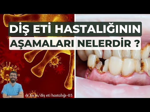 Diş Eti Hastalığının Aşamaları Nelerdir? | Gingivitis ve Periodontitis | Diş Eti Hastalıkları-03