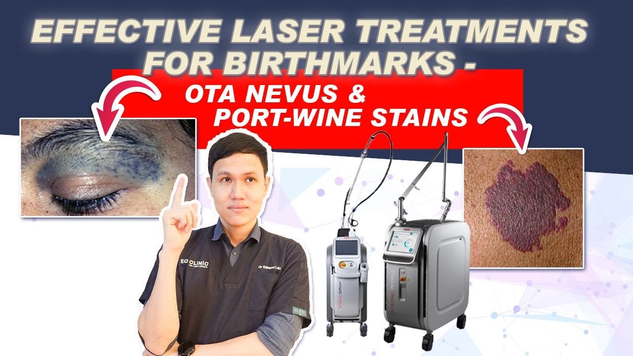 PicoPlus & Derma-V Laser for Birthmark Removal | Ota Nevus & Port-Wine ...