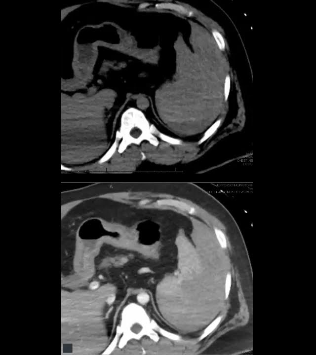 AAST Grade 4 splenic laceration - YouTube