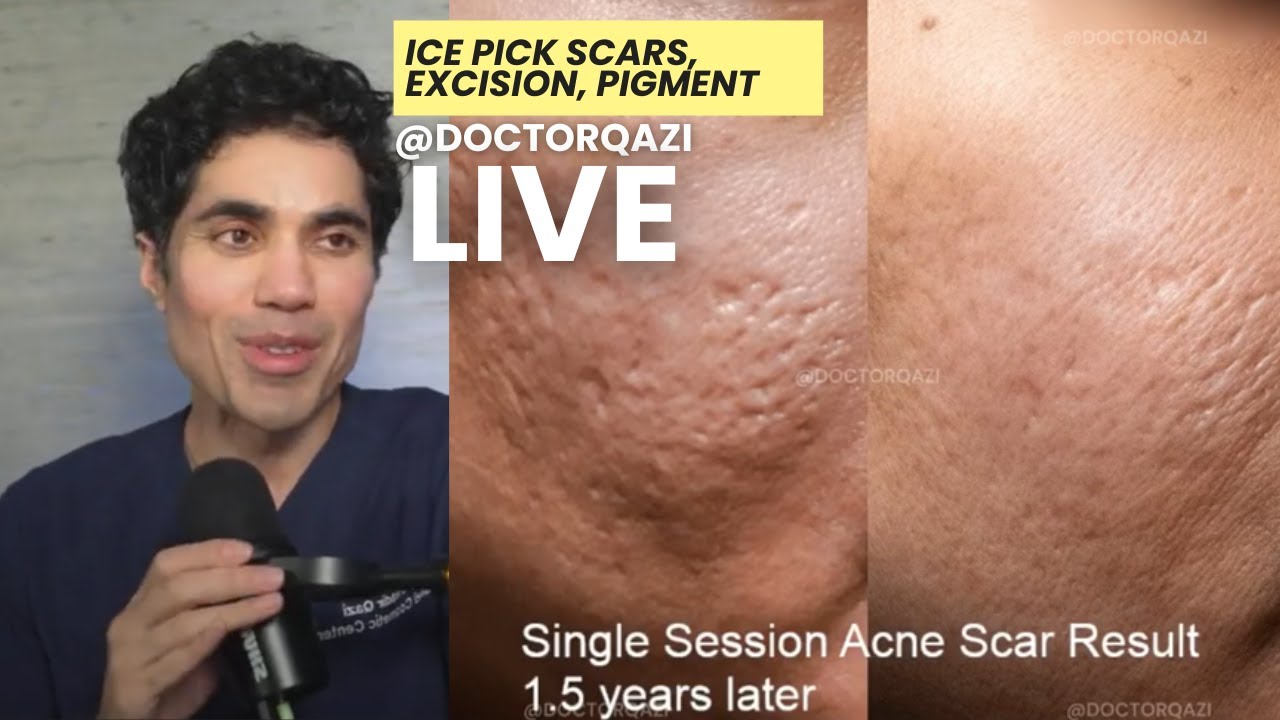 Dr. Qazi discusses Ice Pick Scars, Excision, Pigmentation | Dr. Qazi ...