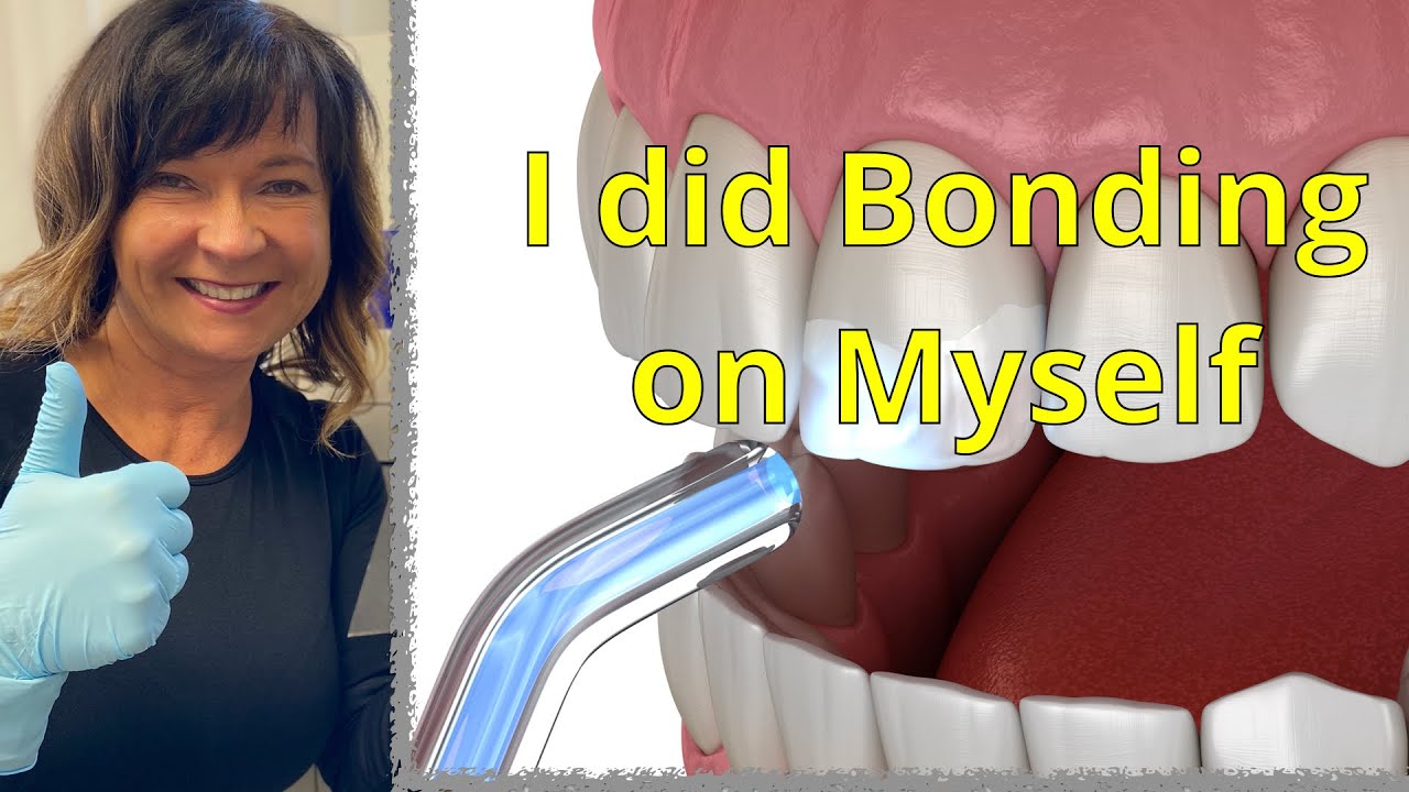 Dental Bonding by Oakville Dentist - How it's done - YouTube