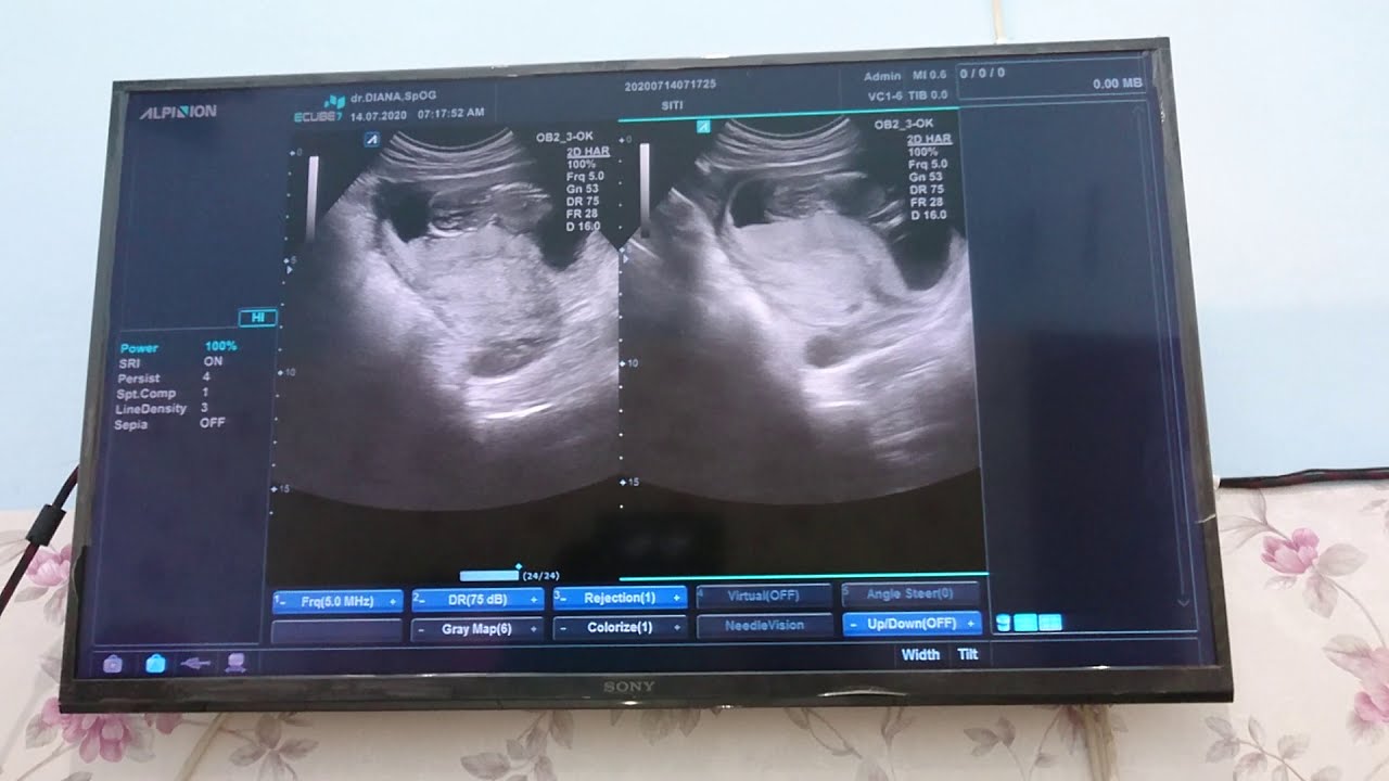 USG 2D janin usia 13 Minggu / 13 week - YouTube