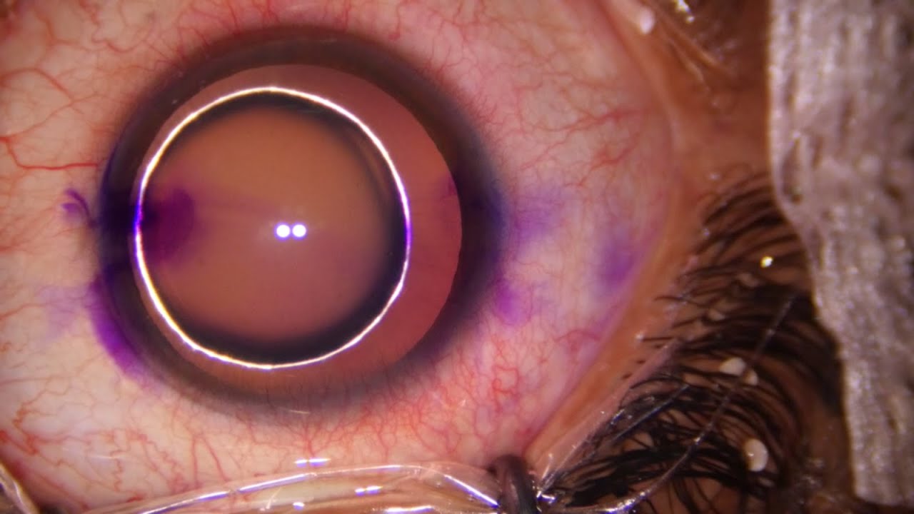MICROSPHEROPHAKIA WITH ZONULOPATHY - CTR & CTS - YouTube