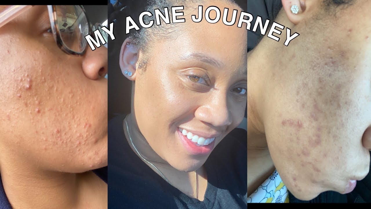 Acne journey: month by month pictures using Doxycycline and Epiduo ...