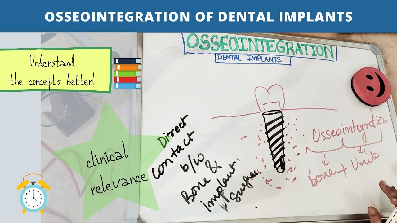 osseointegration of dental implants (Part - 1) - YouTube