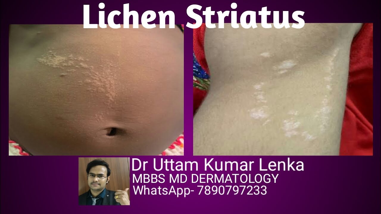 lichen striatus/treatment?sudden straight white /red rashes on skin ...