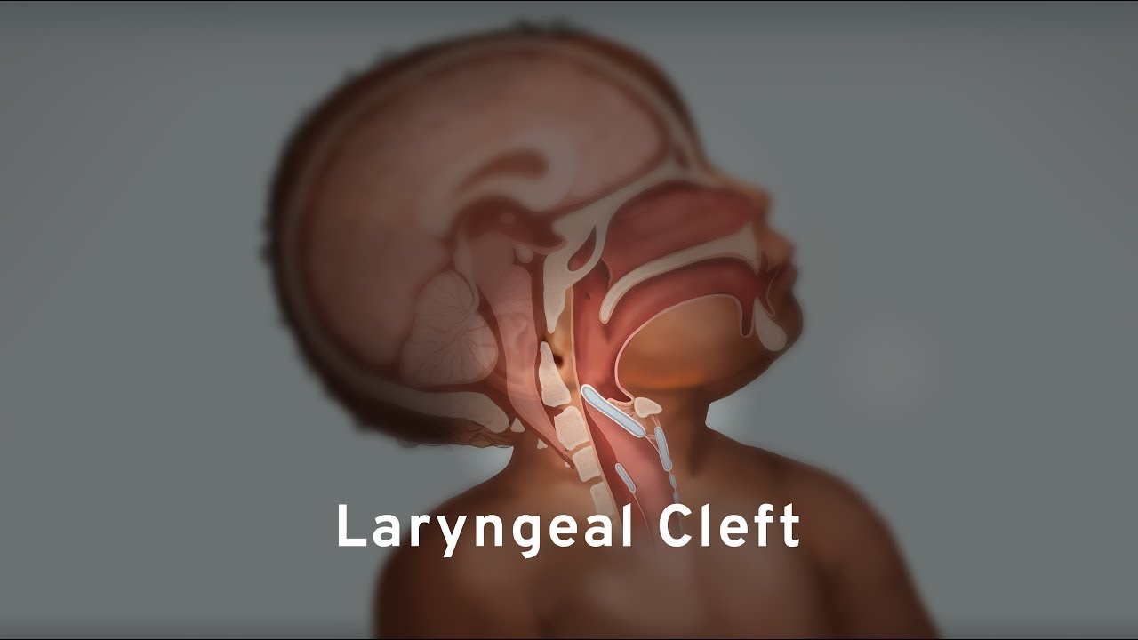 Laryngeal Cleft by J. Laird-Gion et al. | OPENPediatrics - YouTube