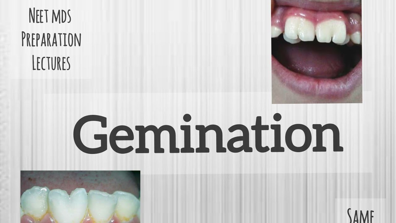 Gemination | Oral pathology | NEET MDS - YouTube