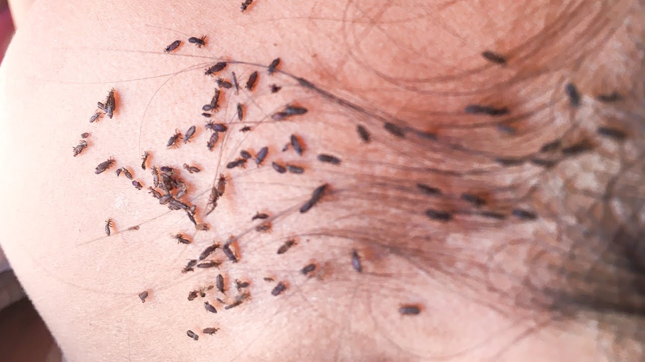 Getting All Lice From Long Hair & Black Hair - Picking Out All Lice ...