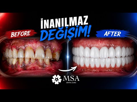     Doğal Görünümlü İmplant Tedavisi | All-On Six