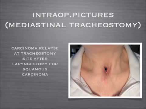 mediastinal tracheostomy cadaver dissection. traqueostomía mediastínica ...