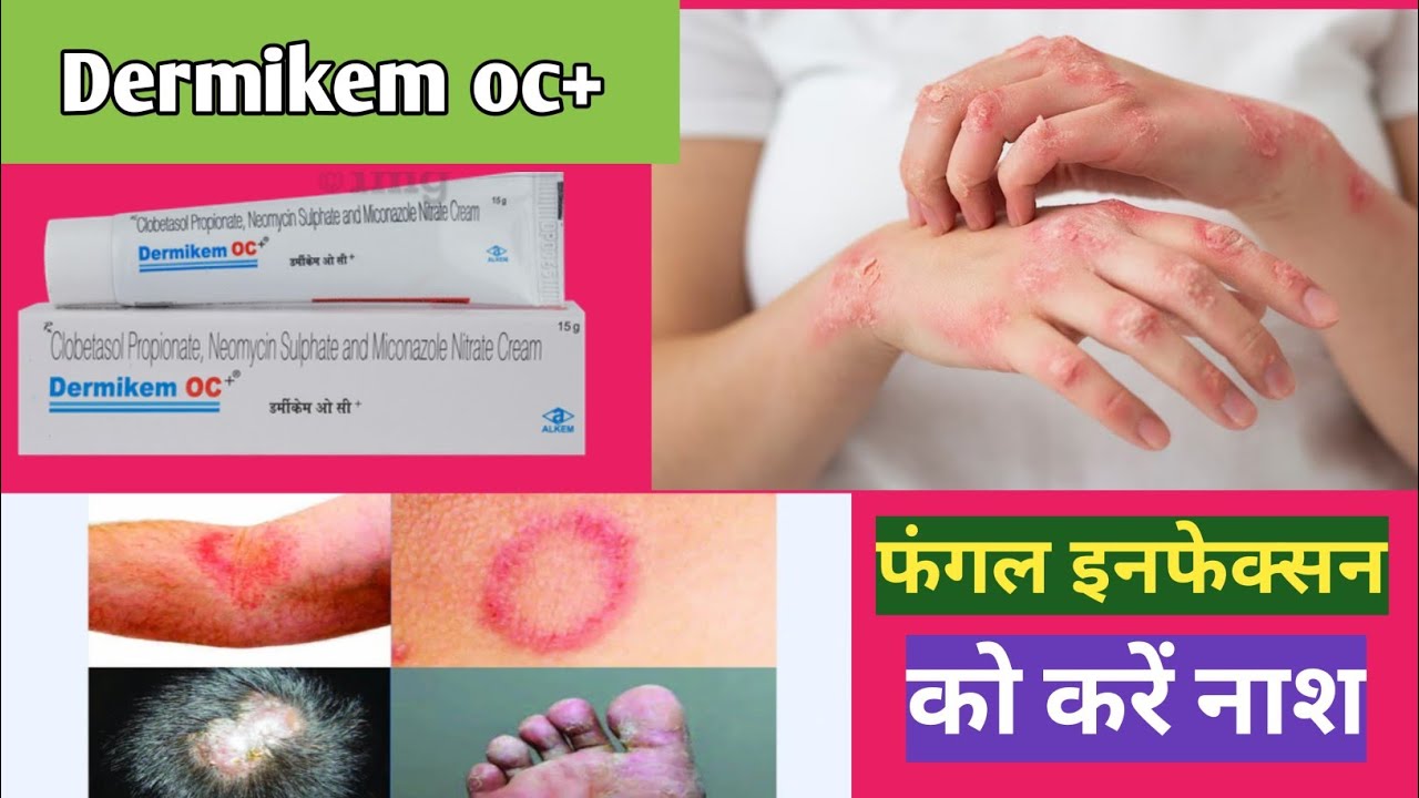 Dermikem oc+ cream review। uses and benefits Hindi me। side effects ...