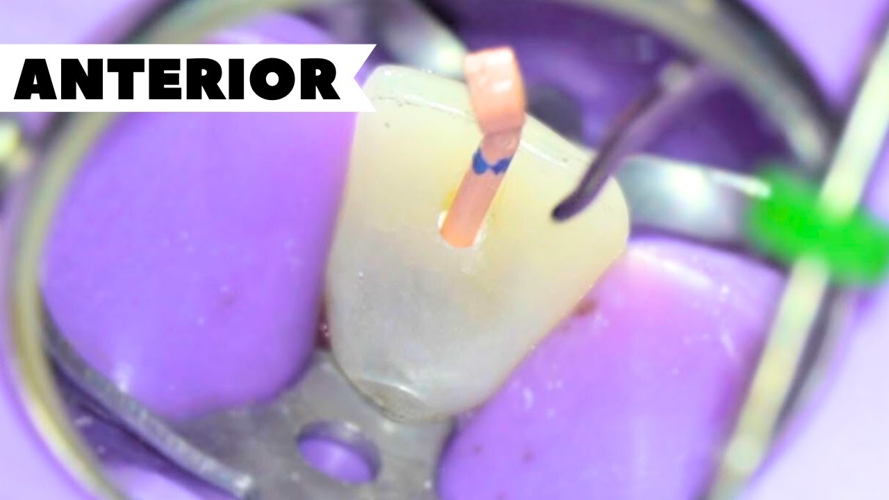 Anterior Root Canal Treatment | Maxillary Anterior Access - YouTube
