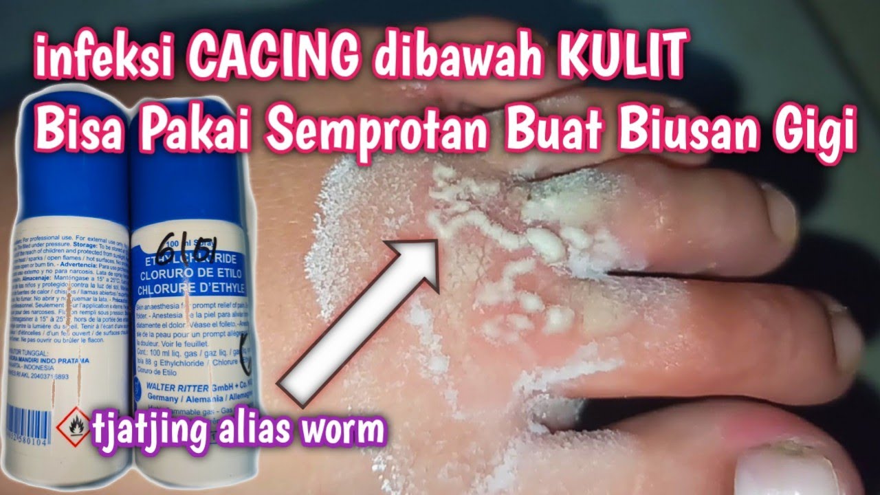 Infeksi Cacing Tambang Di Kulit CLM Cutaneus Larva Migrans Bisa Matiin ...