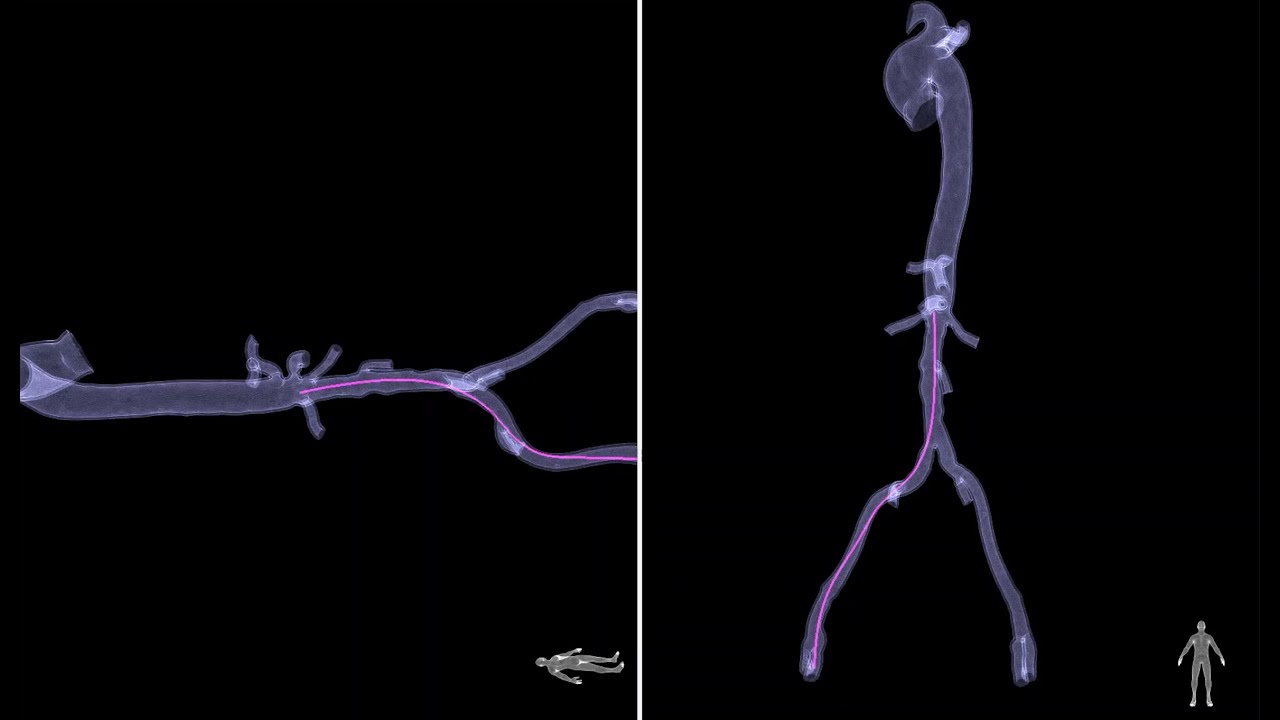 3D Guidance Using Fiber Optic Shape Sensing - YouTube