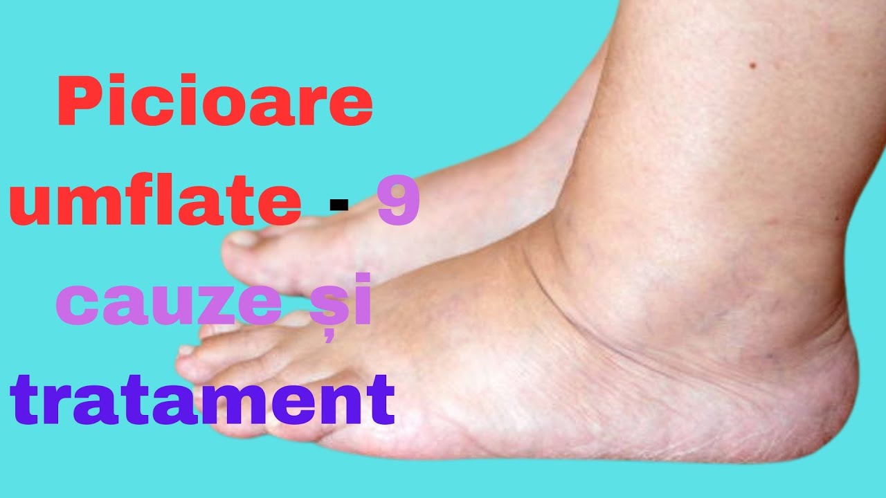 Picioare umflate – 9 cauze și tratamente naturiste #picioareumflate # ...