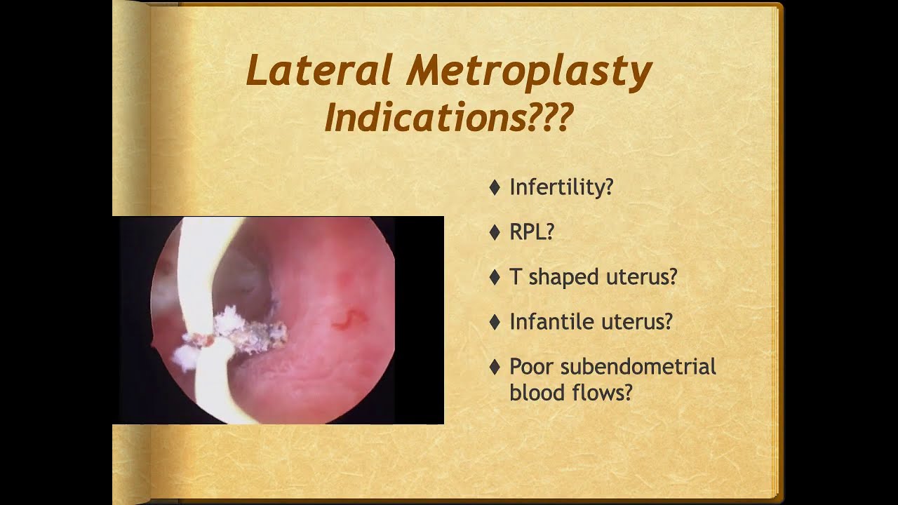 Lateral Metroplasty - YouTube