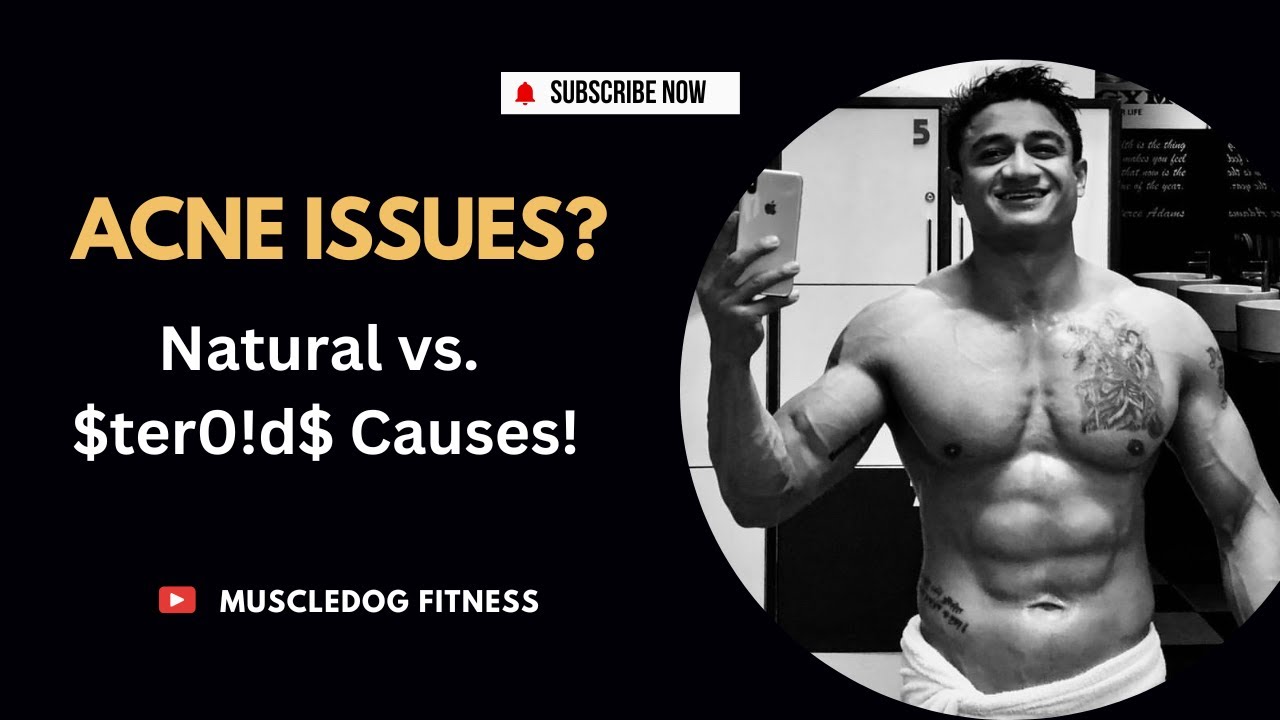 Acne & Steroids: Causes, Prevention & Treatment Explained | in Hindi ...