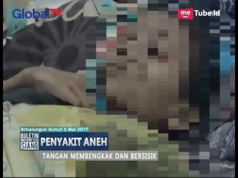 Seorang Siswi Kelas 3 SMA Menderita Penyakit Aneh dan Langka - BIS 03/05